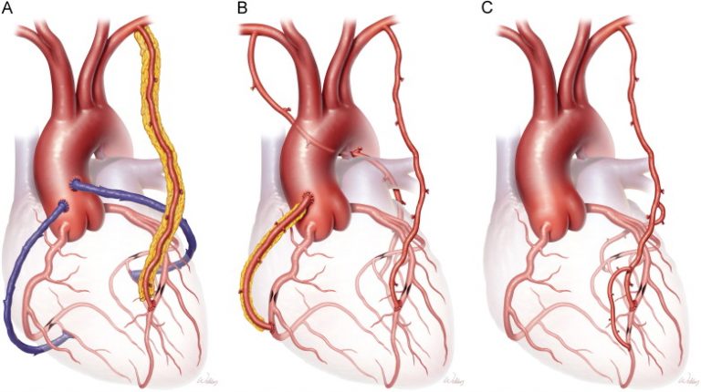 Global Coronary Artery Bypass Grafts Market Insights Report 2020 ...